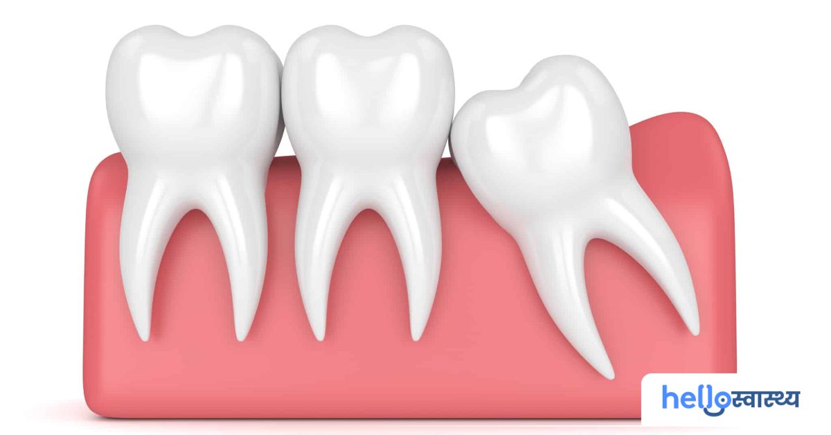 अकल दाढ़ निकलवाना क्यों होता है अच्छा? हैलो स्वास्थ्य