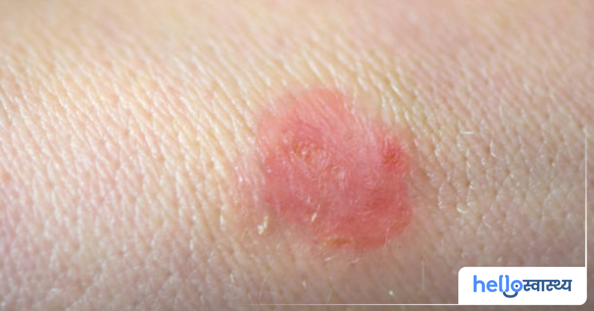 Circular Rash: सर्क्युलर रैश के बारे में जानें विस्तार से - हैलो स्वास्थ्य