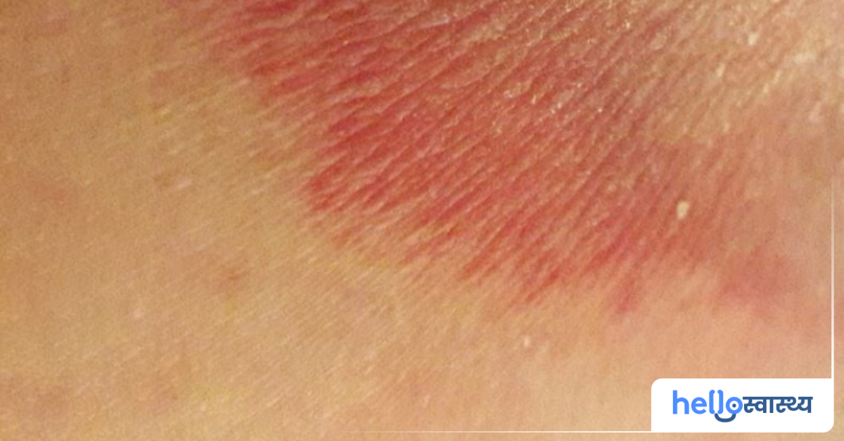 Jock Itch : जॉक इच खुजली क्या है? जानें इसके कारण, लक्षण और उपाय - हैलो ...