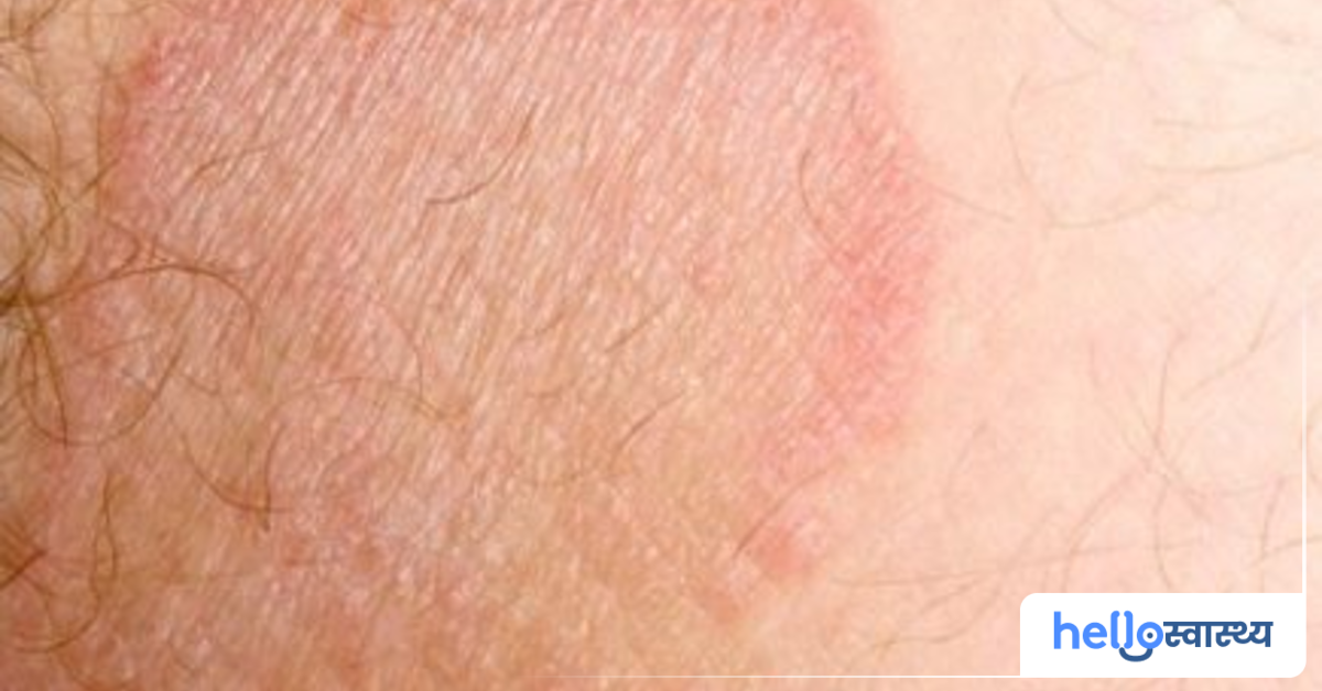 Tinea Cruris: टीनिया क्रूरिस क्या है? लक्षण, इलाज, परिणाम - हैलो स्वास्थ्य